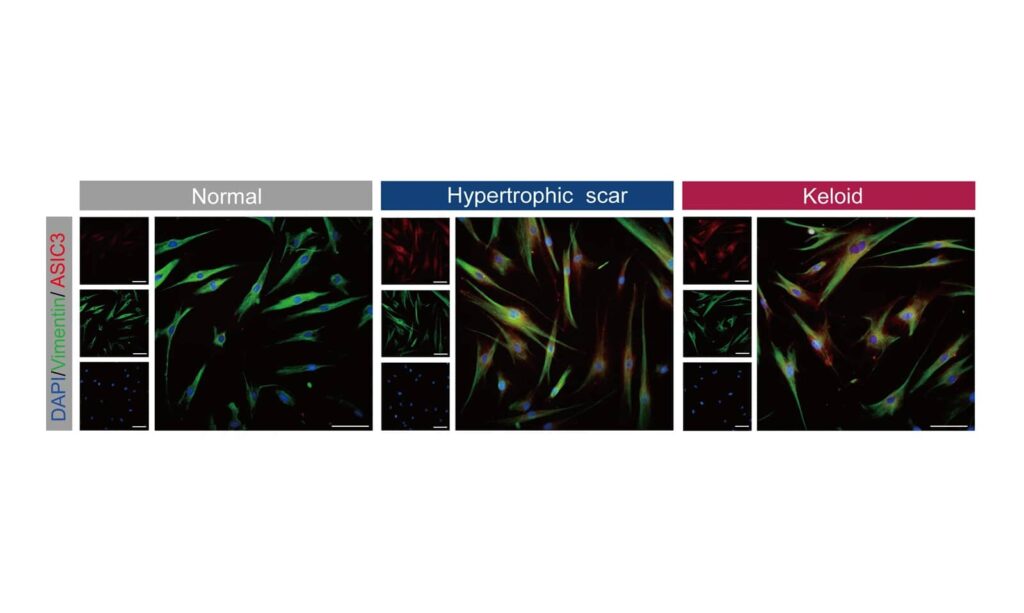 The Role of ASIC3 in Skin Fibrosis: A Feedback Loop That Goes Beyond ...